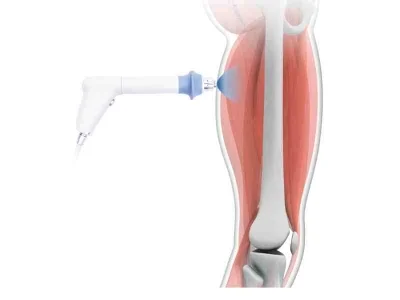 BTL 6000 Radiale shockwave - PRO